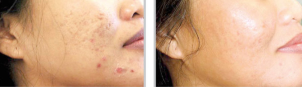 ProFractional Laser Treatments | North Dallas Medspa | Plano, Frisco ...