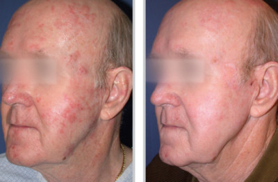 ProFractional Laser Treatments | North Dallas Medspa | Plano, Frisco ...